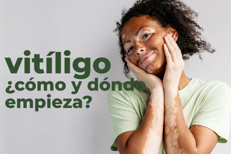 ¿Qué es el Vitíligo? Causas, Tratamiento y Cómo empieza